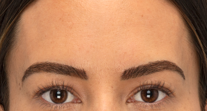 The Look of 3℠ | BOTOX® Cosmetic (onabotulinumtoxinA)